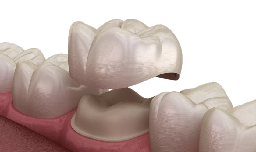 Your Guide to Dental Crown Care in Highlands Ranch